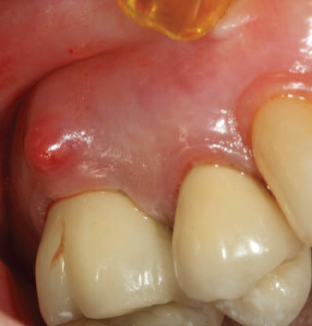 l' abcès parodontal aigu