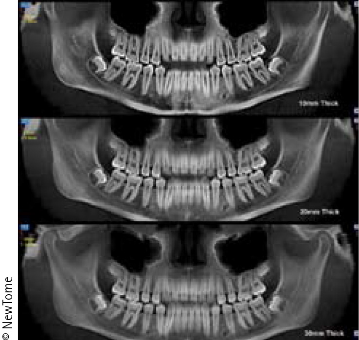 La radiographie dentaire 3D