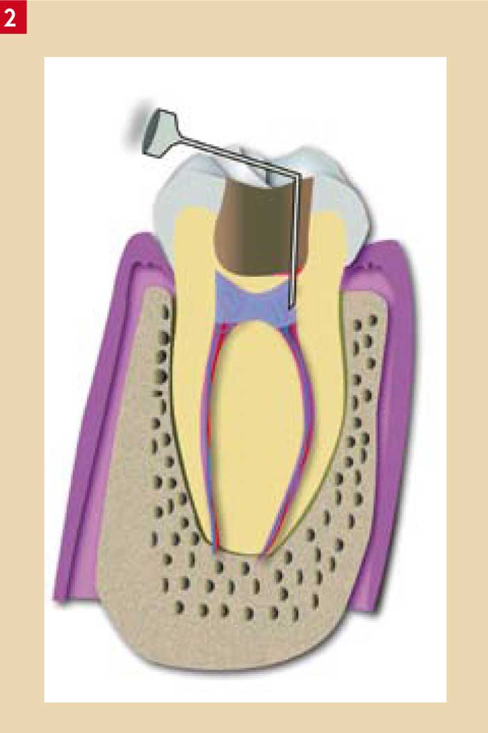 Anesthésie et urgence endodontique