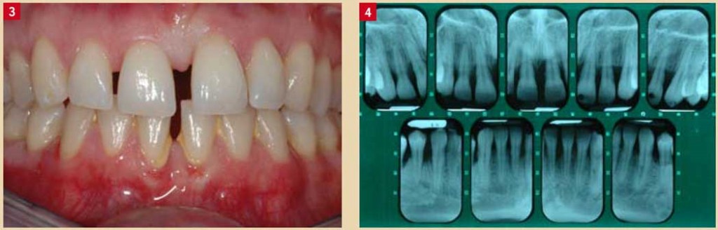 Les antibiotiques et les antiseptiques en parodontologie