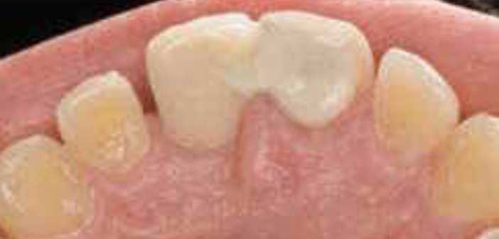 Bridge collé cantilever en céramique de haute ténacité assemblé à l ...