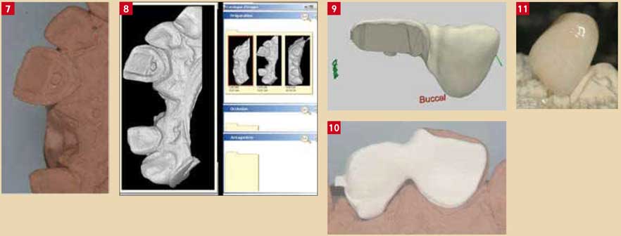 Bridge collé cantilever en céramique de haute ténacité assemblé à l ...