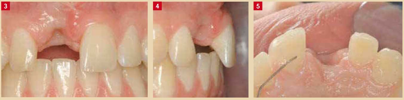 Bridge collé cantilever en céramique de haute ténacité assemblé à l ...