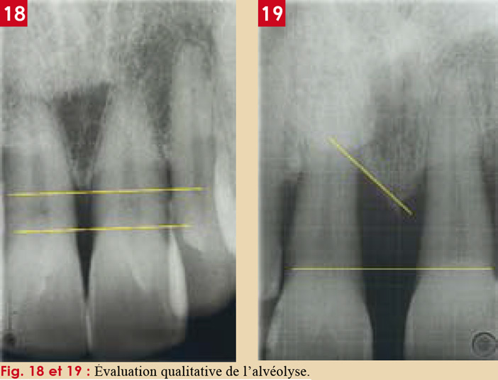 Radiographie De La Maladie Parodontale Radio Panoramique Dentaire Prix