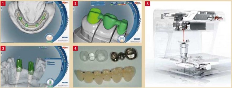 La nouvelle génération Procera de Nobel Biocare