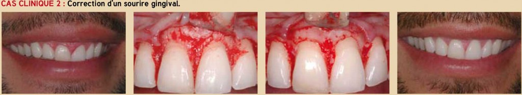 Préparation parodontale pré-prothétique sur parodonte sain ...