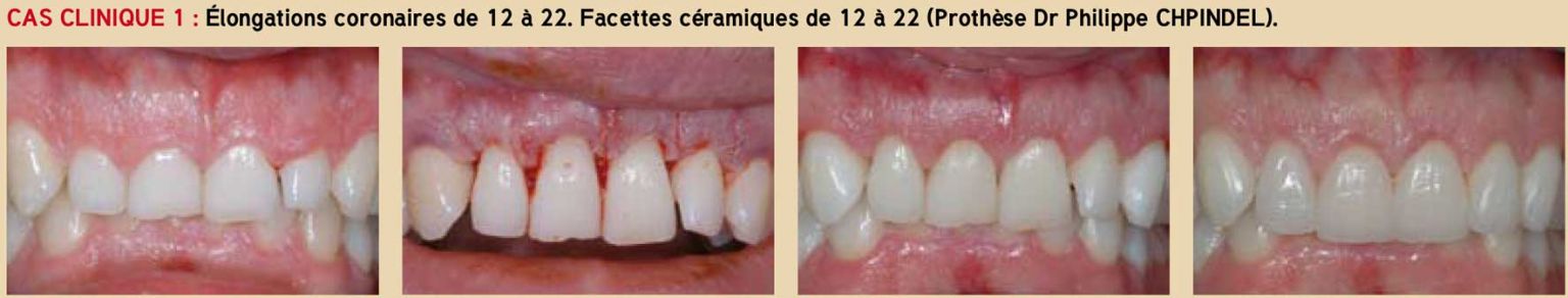 Préparation parodontale pré-prothétique sur parodonte sain ...