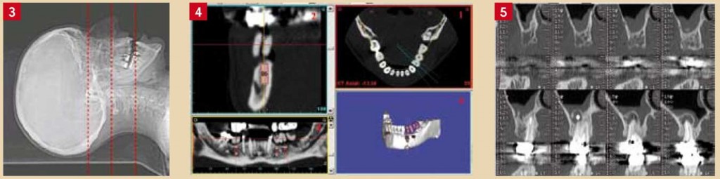 Radiologie conventionnelle et scanner en implantologie