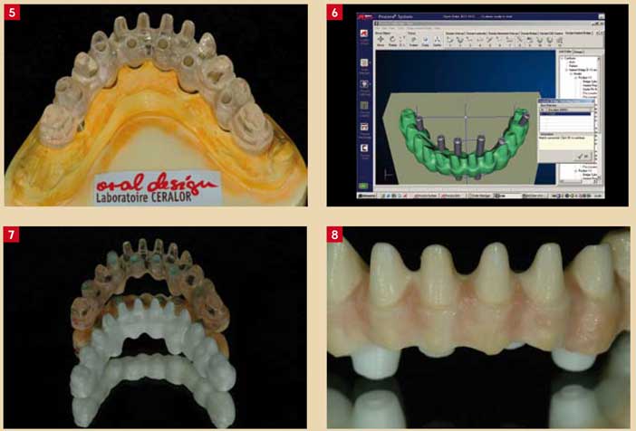 La prothèse numérique au laboratoire