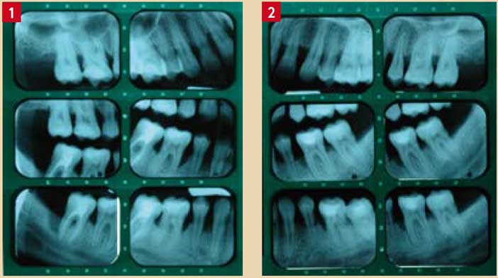 Les antibiotiques et les antiseptiques en parodontologie