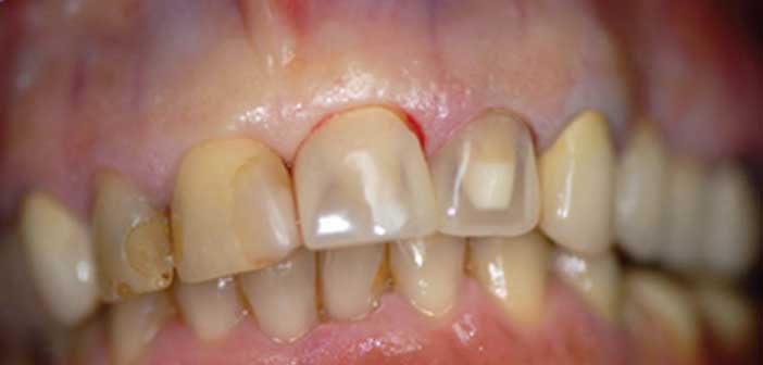 Préparation parodontale pré-prothétique sur parodonte sain ...