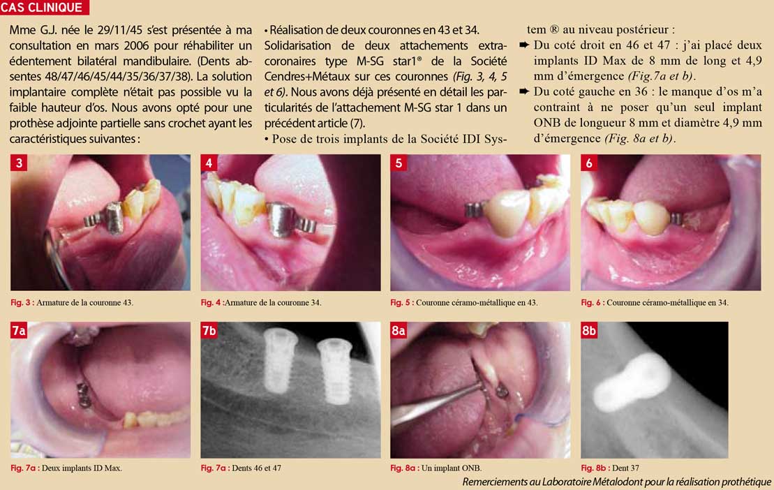 Quadrilatère d’équilibre en prothèse adjointe partielle illustration ...