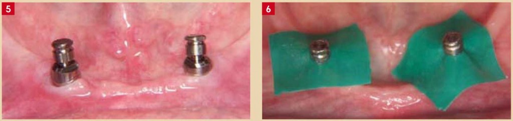 La prothèse adjointe complète supra-implantaire mandibulaire : données actuelles et protocole de ...