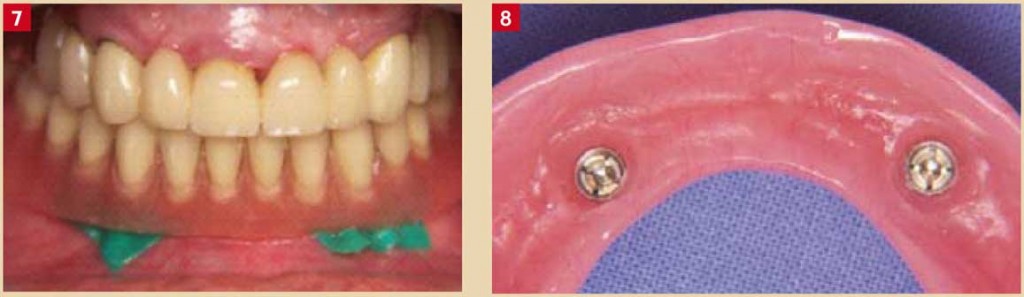 La prothèse adjointe complète supra-implantaire mandibulaire : données actuelles et protocole de ...
