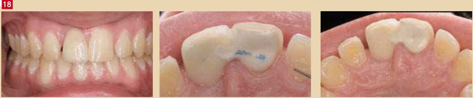 Bridge collé cantilever en céramique de haute ténacité assemblé à l ...