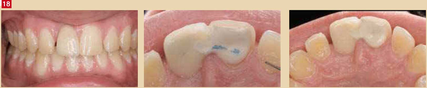 Bridge collé cantilever en céramique de haute ténacité assemblé à l ...