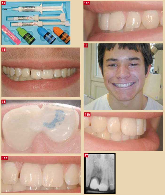 Bridge collé cantilever en céramique de haute ténacité assemblé à l ...