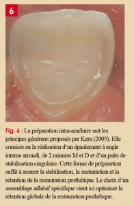 Bridge collé cantilever en céramique de haute ténacité assemblé à l ...
