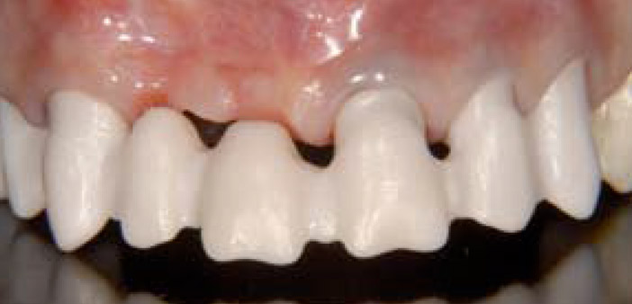 L’utilisation de la zircone au quotidien