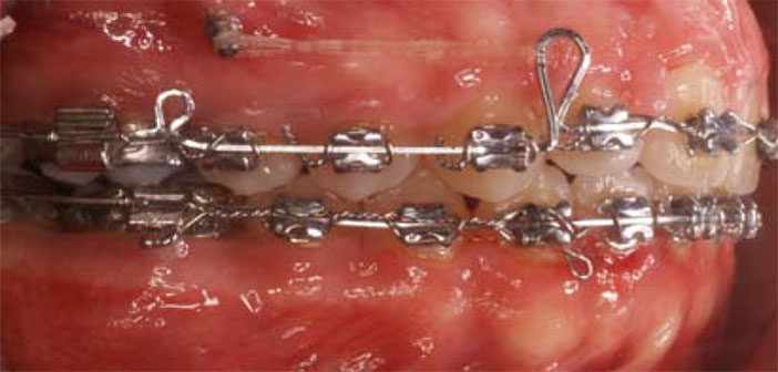 Mini-vis : l’orthodontie de demain