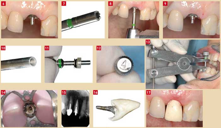 Dépose des ancrages radiculaires métalliques