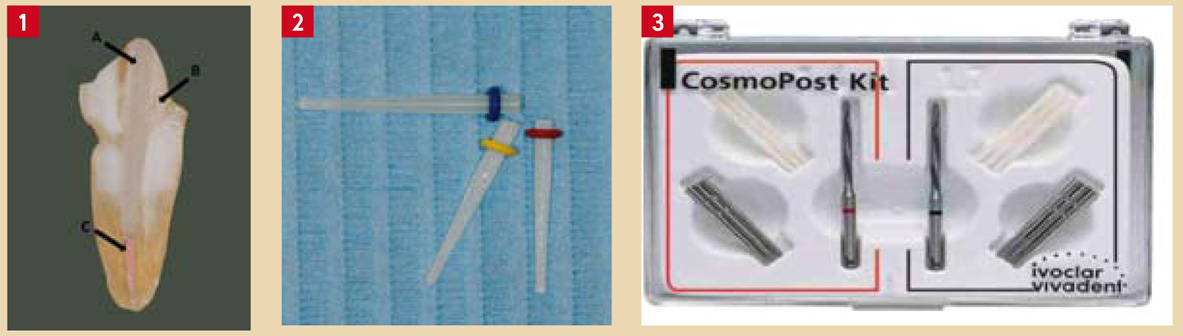 Dépose des tenons fibrés et céramiques sur les reconstitutions corono ...