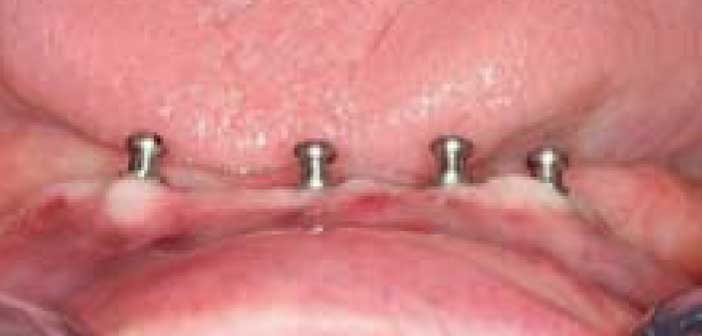 Mise en charge immédiate avec les implants de faible diamètre ATLAS ...
