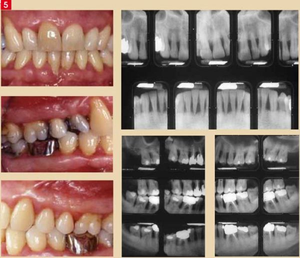 Classification des maladies parodontales