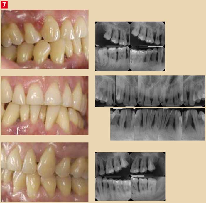 Classification des maladies parodontales