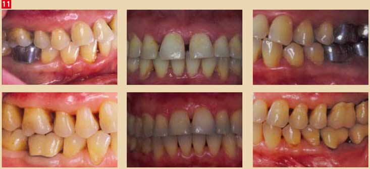 Classification des maladies parodontales