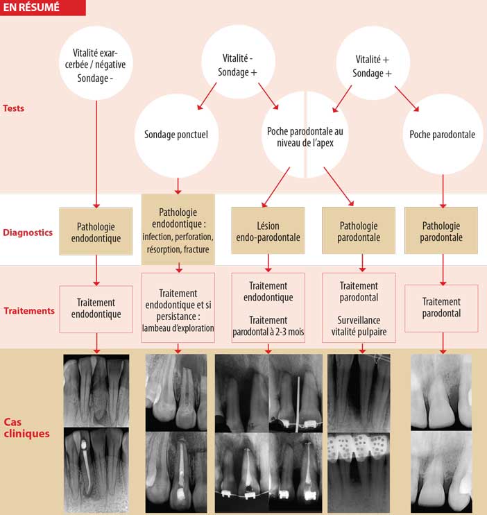 Aborder les lésions endo-parodontales
