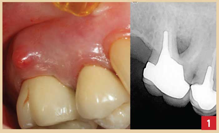 Les urgences en parodontologie