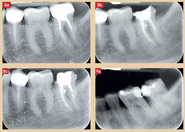 La sélection du cas en endodontie