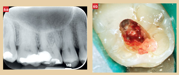 La sélection du cas en endodontie
