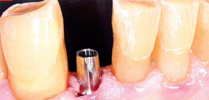 Remplacement « naturel » d'une incisive mandibulaire : vers une ... Remplacement « naturel » d'une incisive mandibulaire : vers une ...