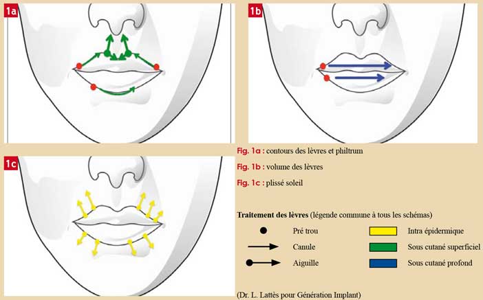 L'acide hyaluronique, les techniques d'injection dans la région péri ...