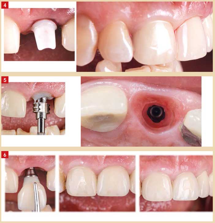 La zone implant-pilier-prothèse