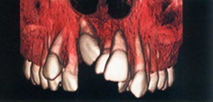 Les dents incluses : Traitement orthodontique et chirurgical