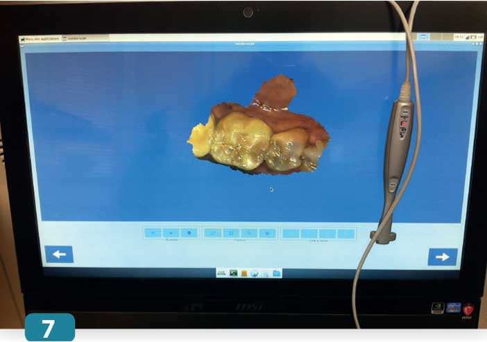 CFAO Dentaire et empreinte optique : les caméras au banc d’essai