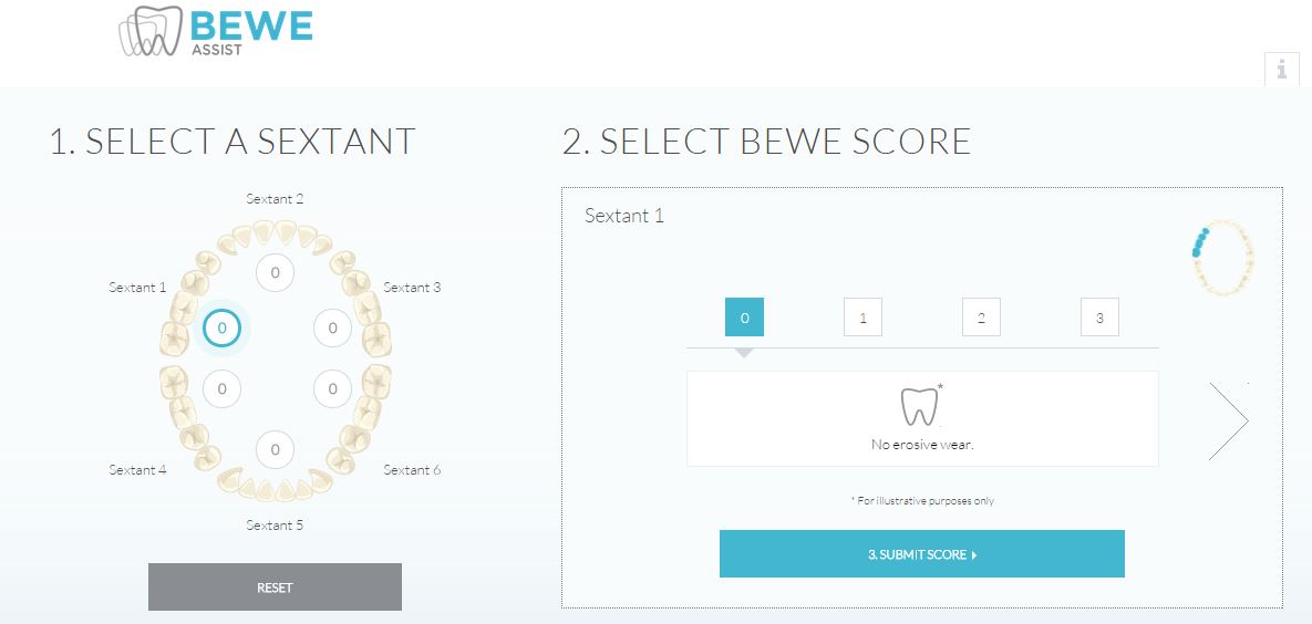 “BEWE Assist” simplifie l’évaluation de l’usure dentaire