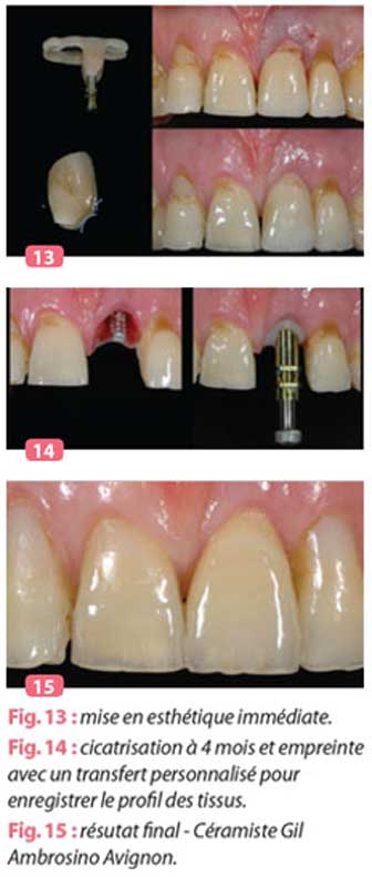Gestion des tissus mous péri-implantaires