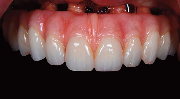 Prédictibilités biologique et esthétique d’une réhabilitation ...