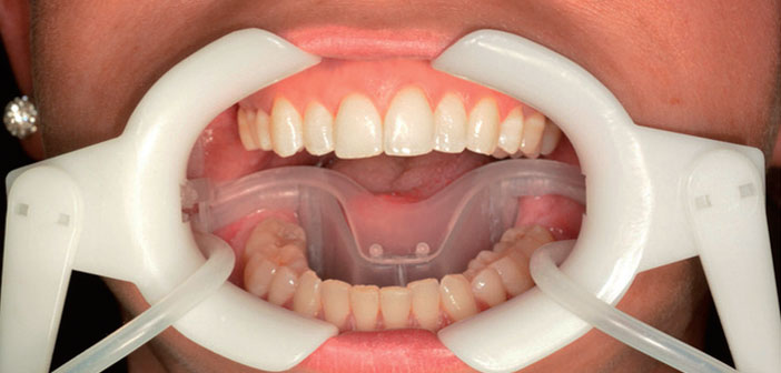 La technique lingual Liberty