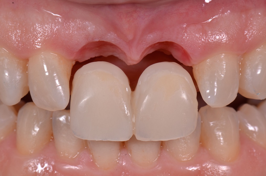 Aménagements Muqueux | IFCIA Hadi Antoun - LEFILDENTAIRE magazine dentaire