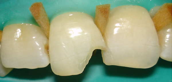 L’utilisation du MTA® dans le traitement de la dent permanente immature ...