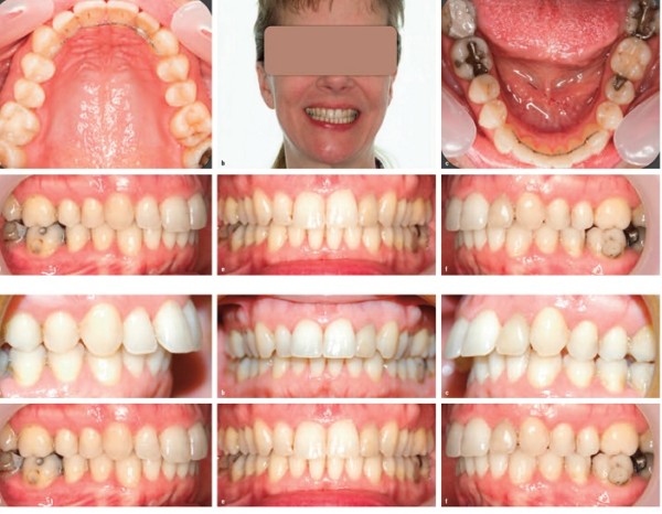 Traitement d’une occlusion de classe II avec orthocaps® et ancrage ...