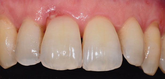 Le « Pink Spot » étiologie et prise en charge