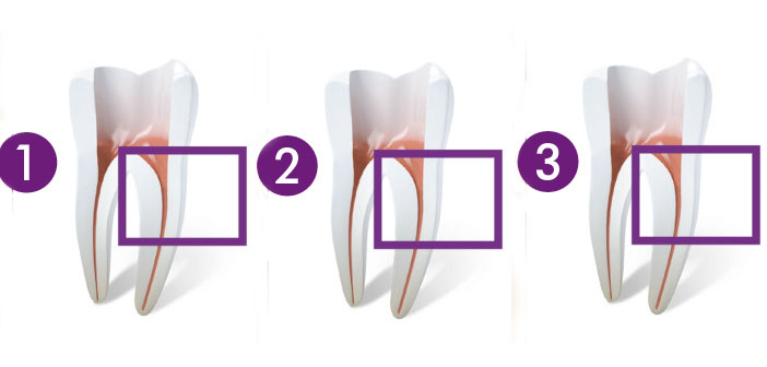 Les 3 étapes d’un traitement endodontique réussi