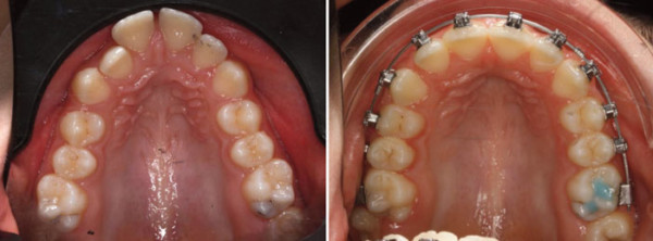 Le set-up numérique la révolution de l’orthodontie digitale
