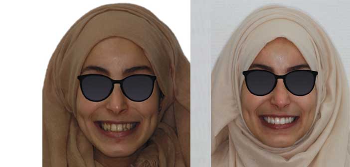 Incisives riziformes gradient thérapeutique et odf, éclaircissement ...